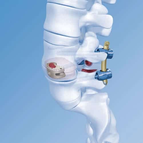 Interventions conventionnelles et mini-invasives - Chirurgie du rachis