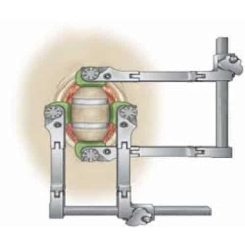 Arthrodèse cervicale et corporectomie - Espace Francilien du Rachis