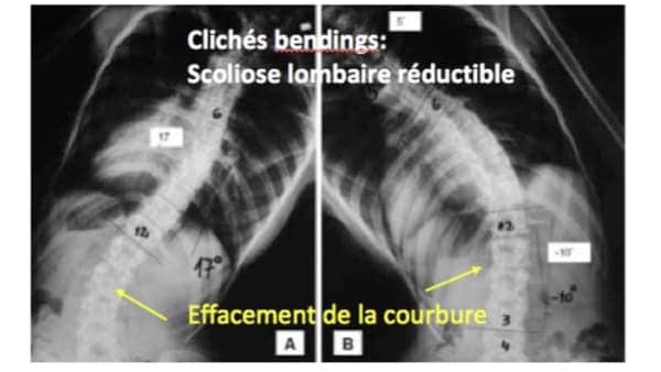 Scoliose de l'adolescent - Espace Francilien du Rachis
