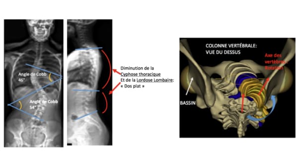 Scoliose de l'adolescent - Espace Francilien du Rachis
