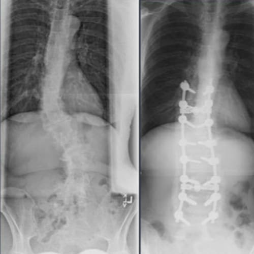 Scoliose de l'adulte : que faire ? - Espace Francilien du Rachis