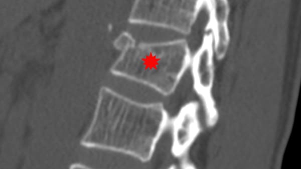 Fractures et tassements vertébraux ostéoporotiques - Chirurgie du rachis